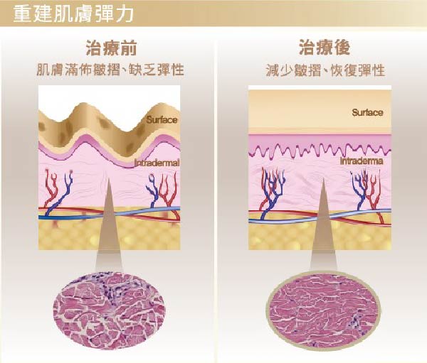 IntraGen電波 | 淨美皮膚科診所